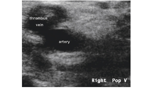 Deep Venous Thrombosis and Pulmonary Thromboembolism - NEWNMCLE